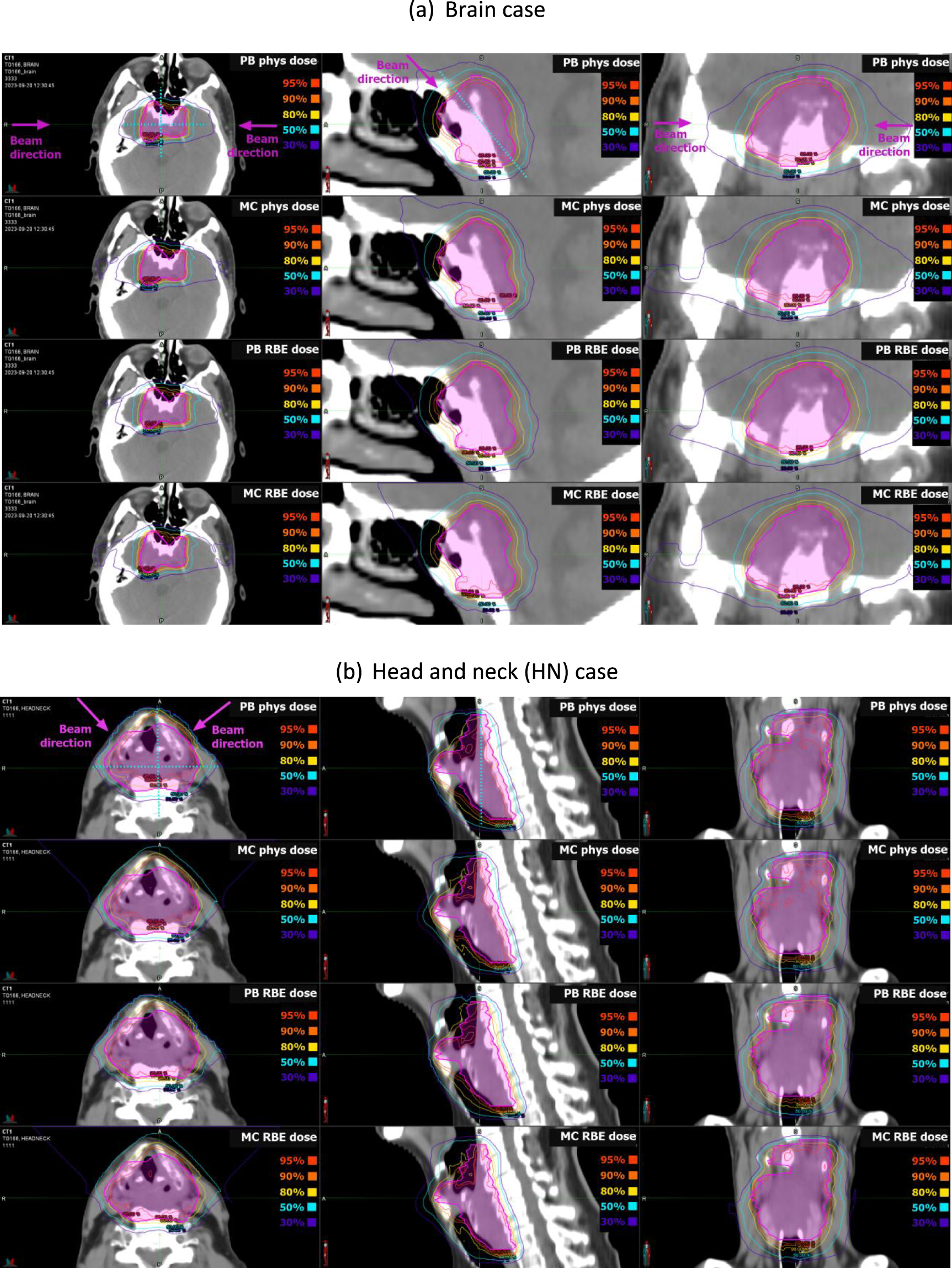 Pioneering MCF MKM RBE-weighted dose calculation for carbon ion ...