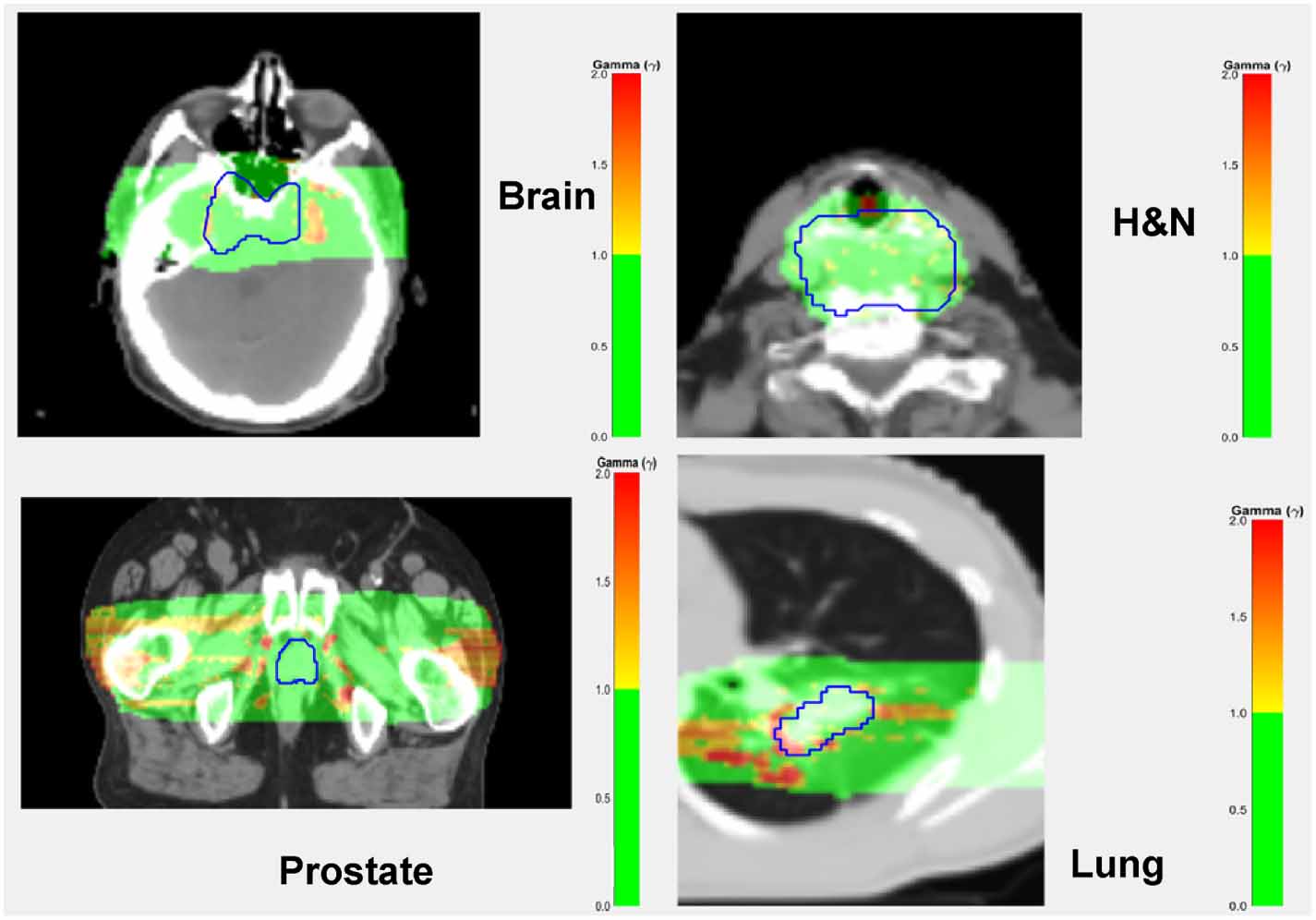 Pioneering MCF MKM RBE-weighted dose calculation for carbon ion ...