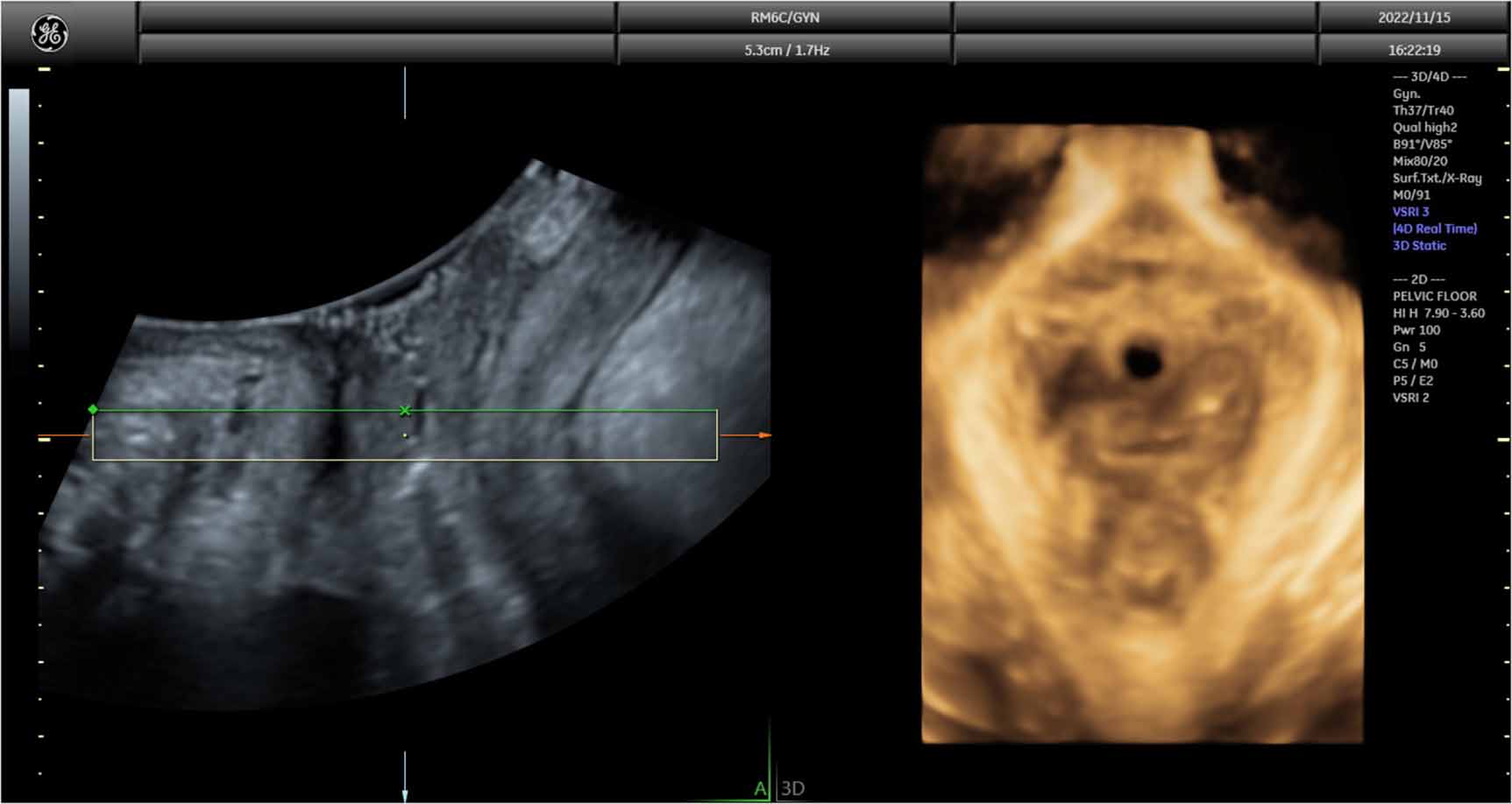 Three-dimensional ultrasound imaging: a review of the technology ...