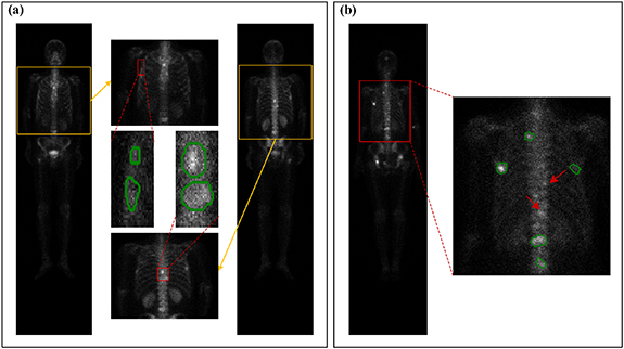 Interactive segmentation for accurately isolating metastatic lesions ...