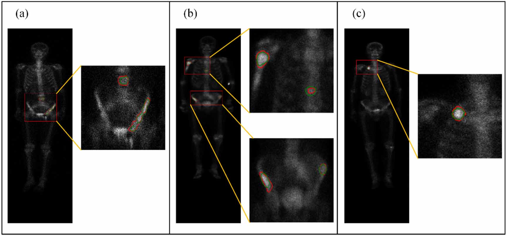 Interactive segmentation for accurately isolating metastatic lesions ...