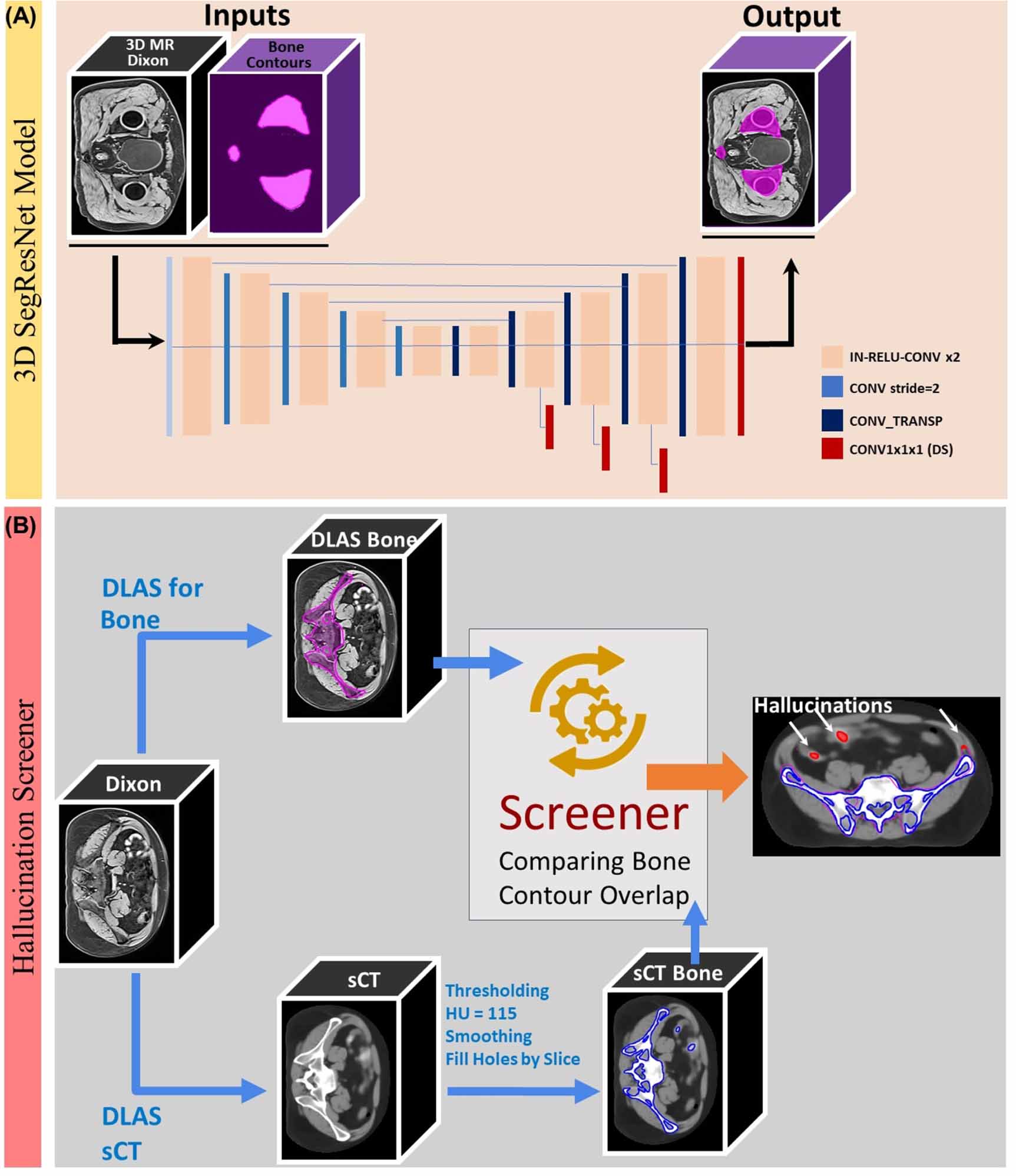 Automated hallucination detection for synthetic CT images used in MR ...