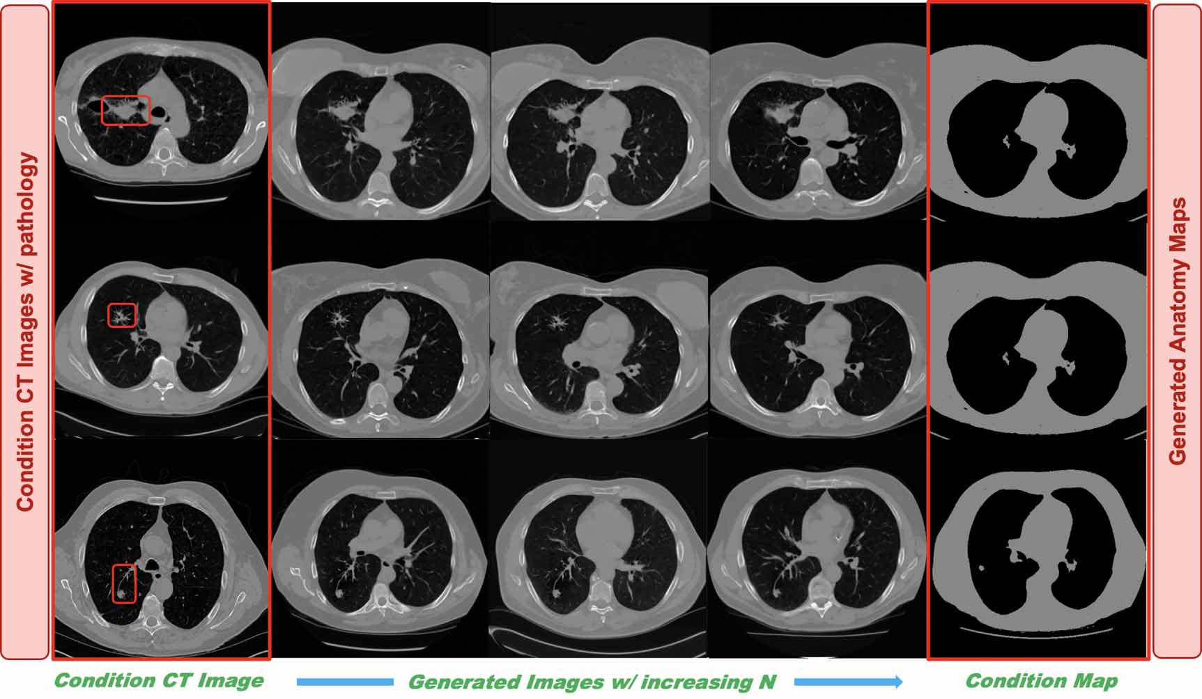 Guided synthesis of annotated lung CT images with pathologies using a ...