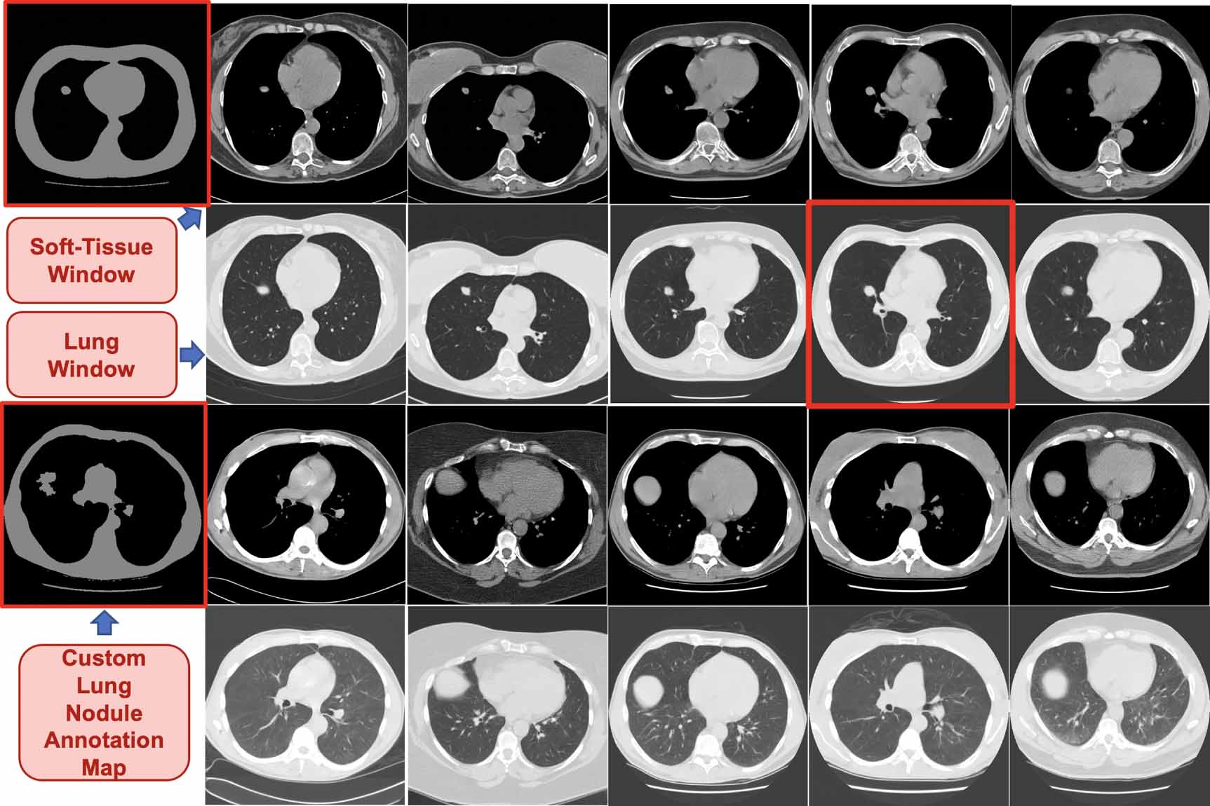 Guided synthesis of annotated lung CT images with pathologies using a ...