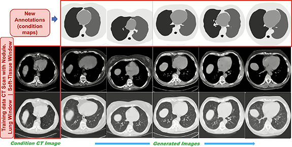 Guided synthesis of annotated lung CT images with pathologies using a ...