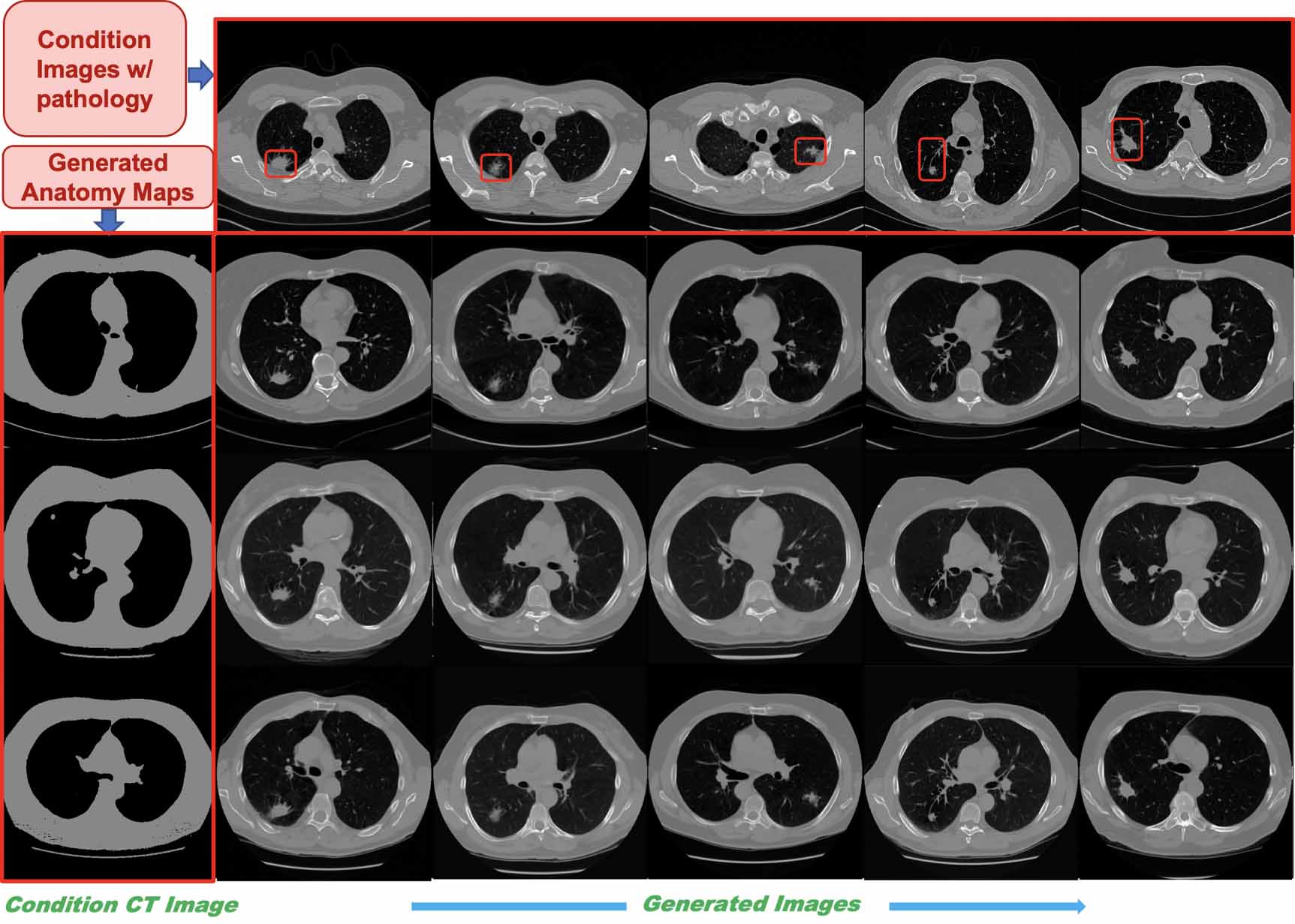 Guided synthesis of annotated lung CT images with pathologies using a ...