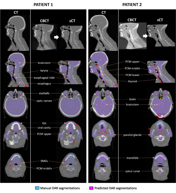 Deep learning-based segmentation of head and neck organs at risk on ...