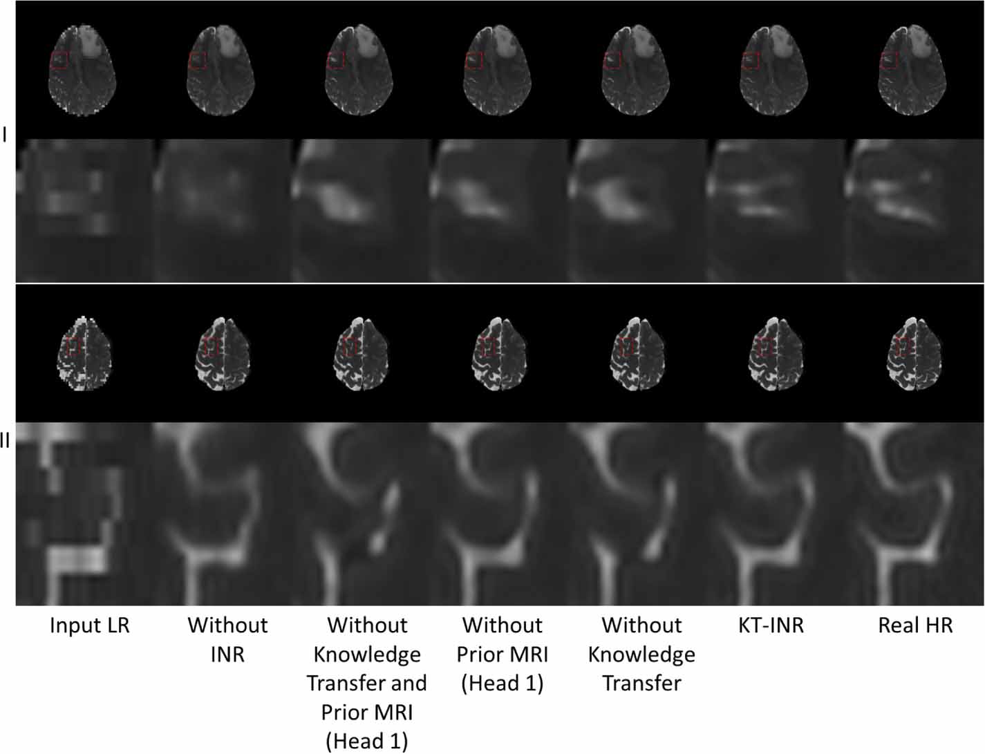 Patient-specific MRI super-resolution via implicit neural ...