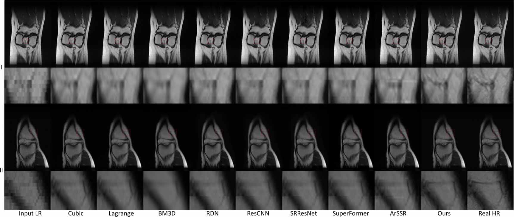 Patient-specific MRI super-resolution via implicit neural ...