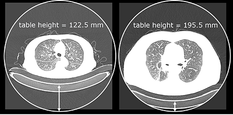 Influence of tube and patient positioning in thoracoabdominal CT ...