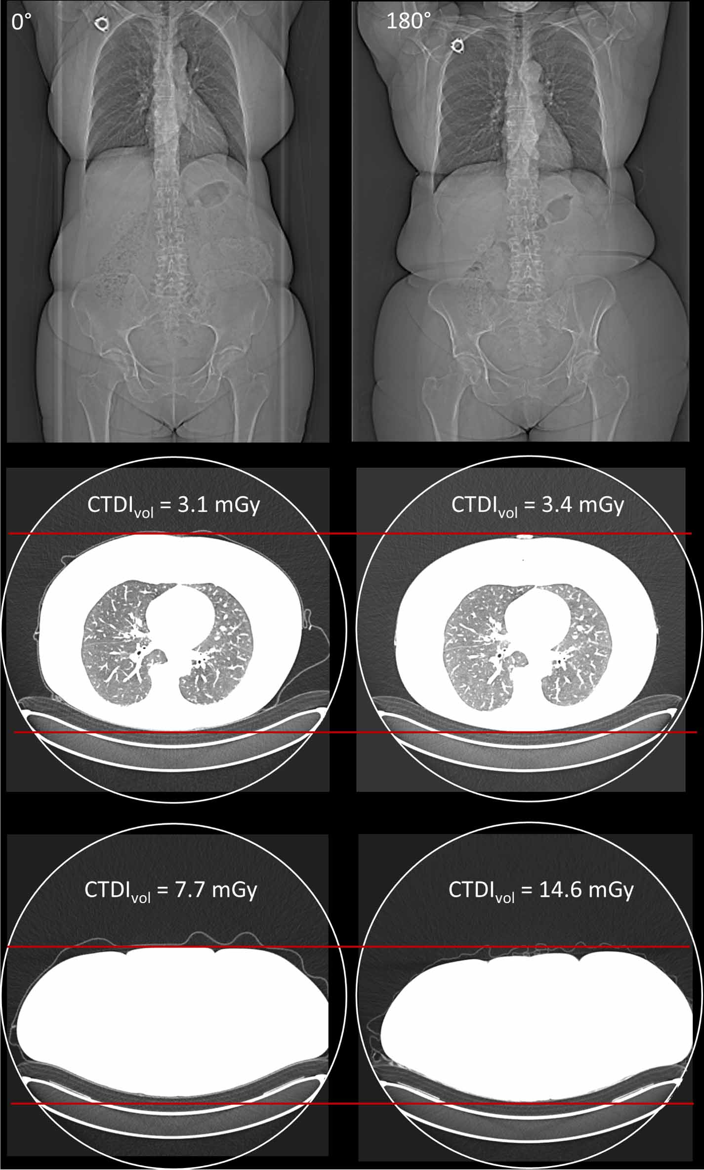 Influence of tube and patient positioning in thoracoabdominal CT ...