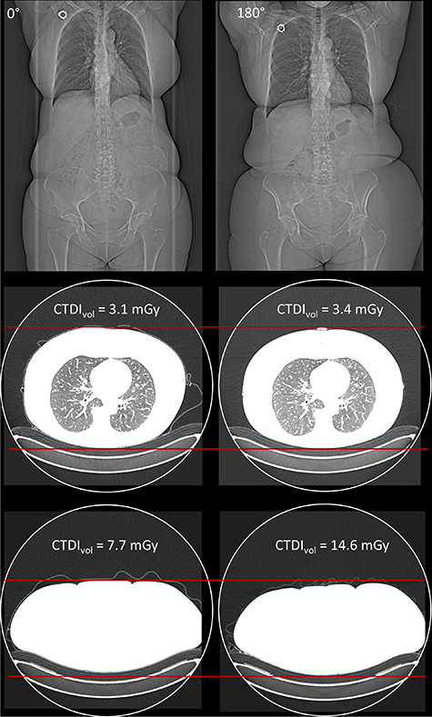 Influence of tube and patient positioning in thoracoabdominal CT ...