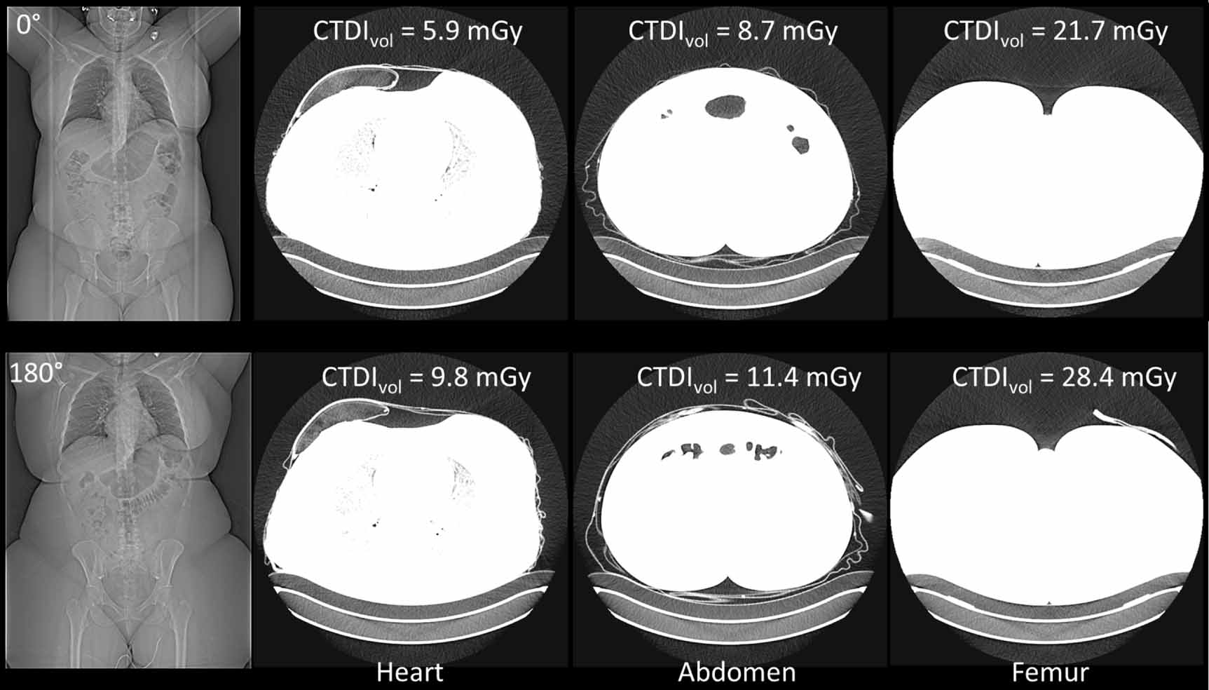 Influence of tube and patient positioning in thoracoabdominal CT ...