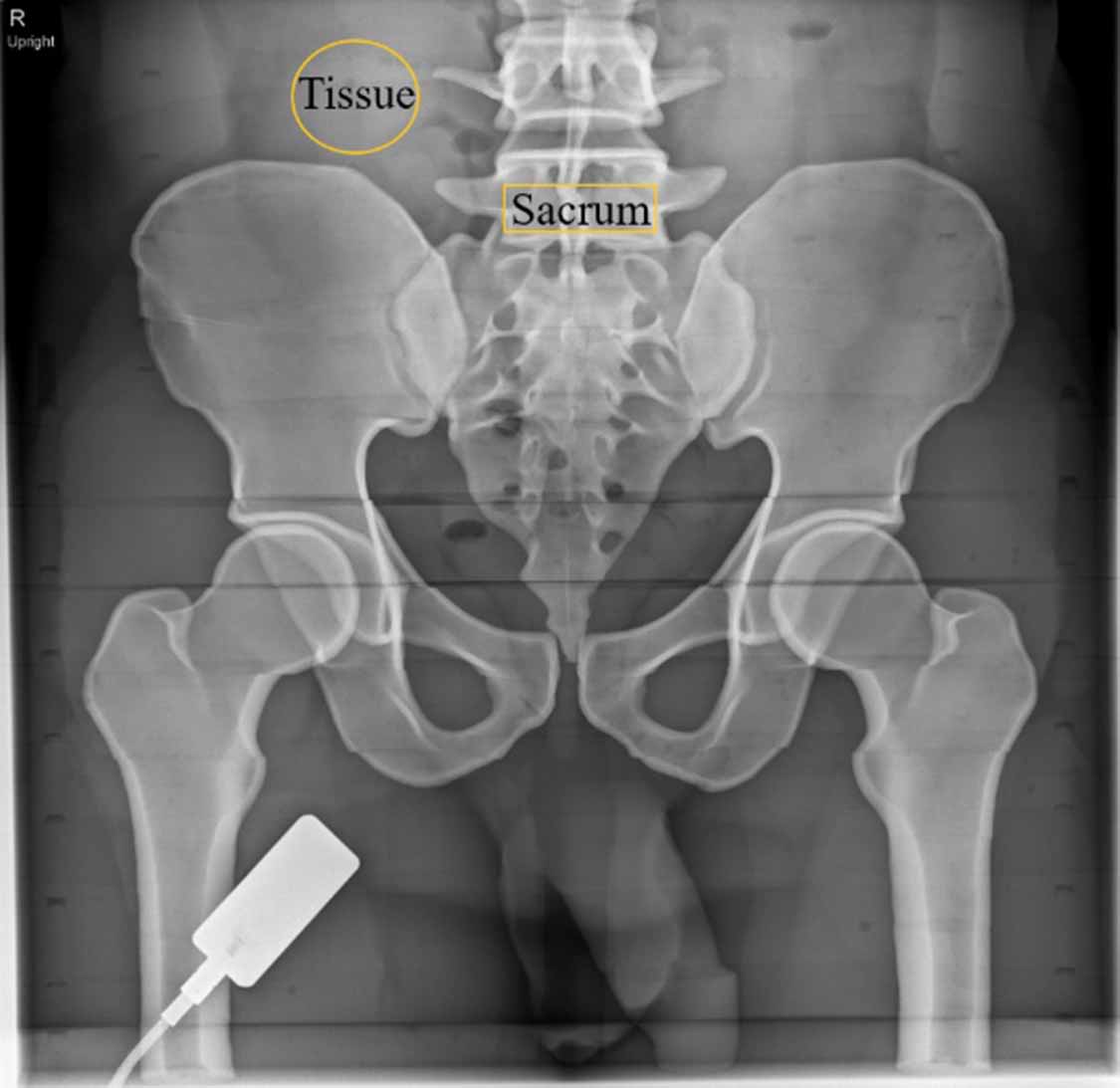 Evaluation of the performance of digital x-ray systems in pelvis ...