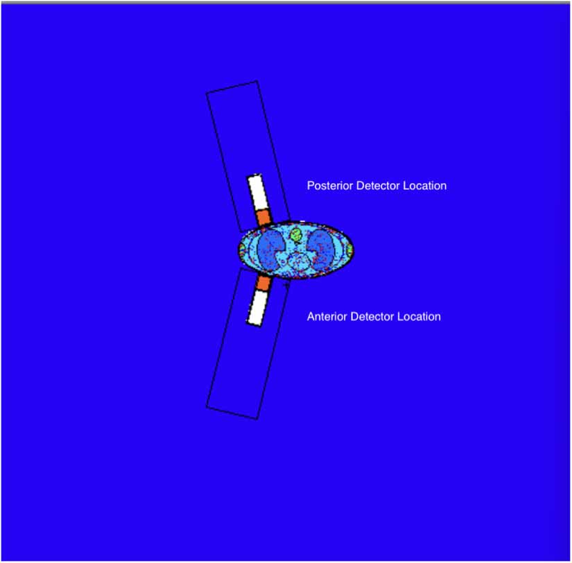 Assessing chest wall thickness sensitivity on in-vivo lung counting ...