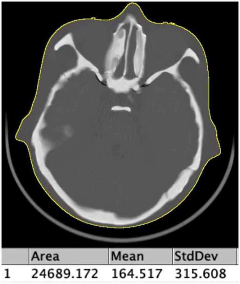 Influence of reference baselines on size-specific dose estimate (SSDE ...