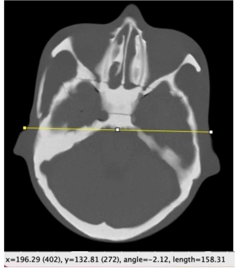 Influence of reference baselines on size-specific dose estimate (SSDE ...