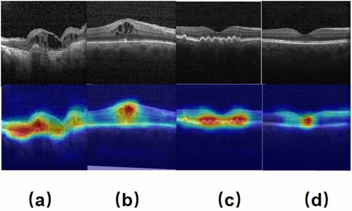 Classification of macular abnormalities using a lightweight CNN-SVM ...
