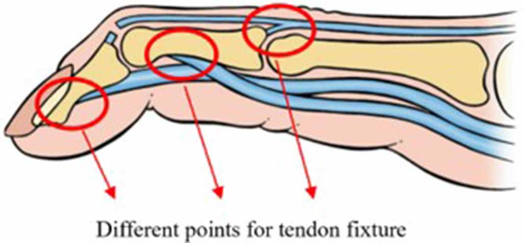 Soft robotic finger with variable effective length enabled by an antagonistic constraint ...