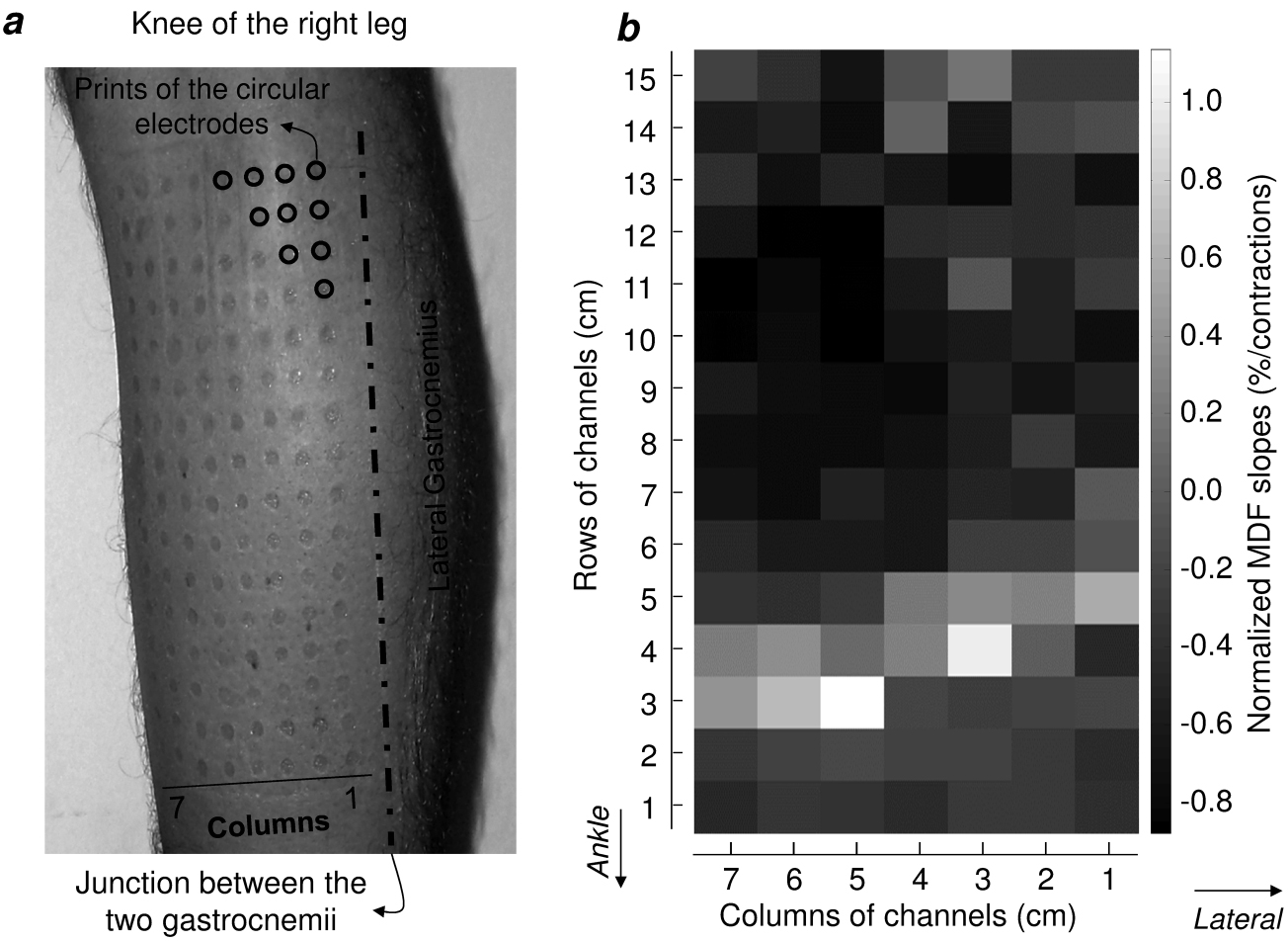 Surface EMG and muscle fatigue: multi-channel approaches to the study ...