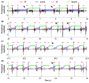 Performance of an open-source heart sound segmentation algorithm on ...