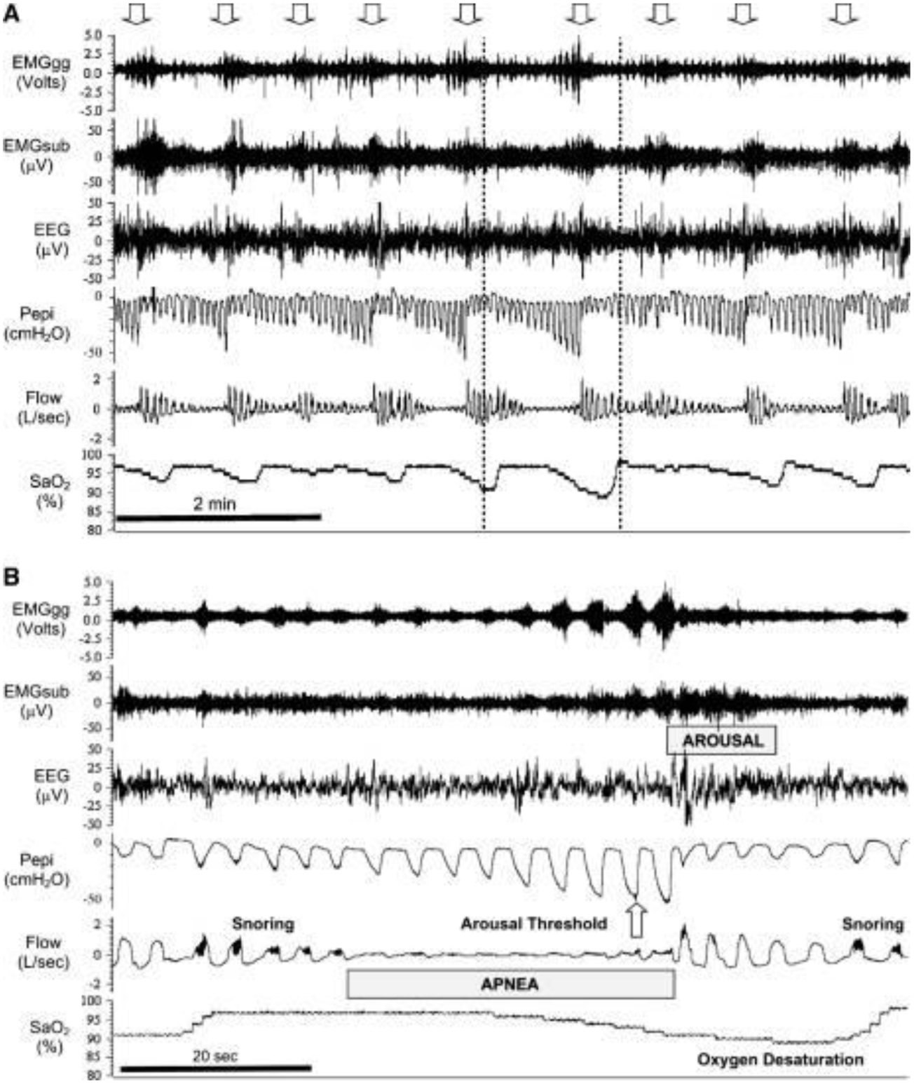 Sleep apnea: a review of diagnostic sensors, algorithms, and therapies ...
