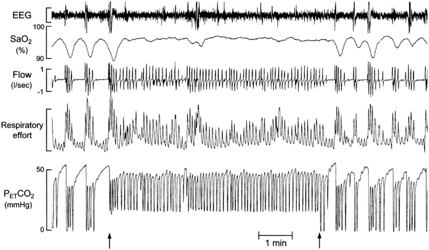 Sleep apnea: a review of diagnostic sensors, algorithms, and therapies ...
