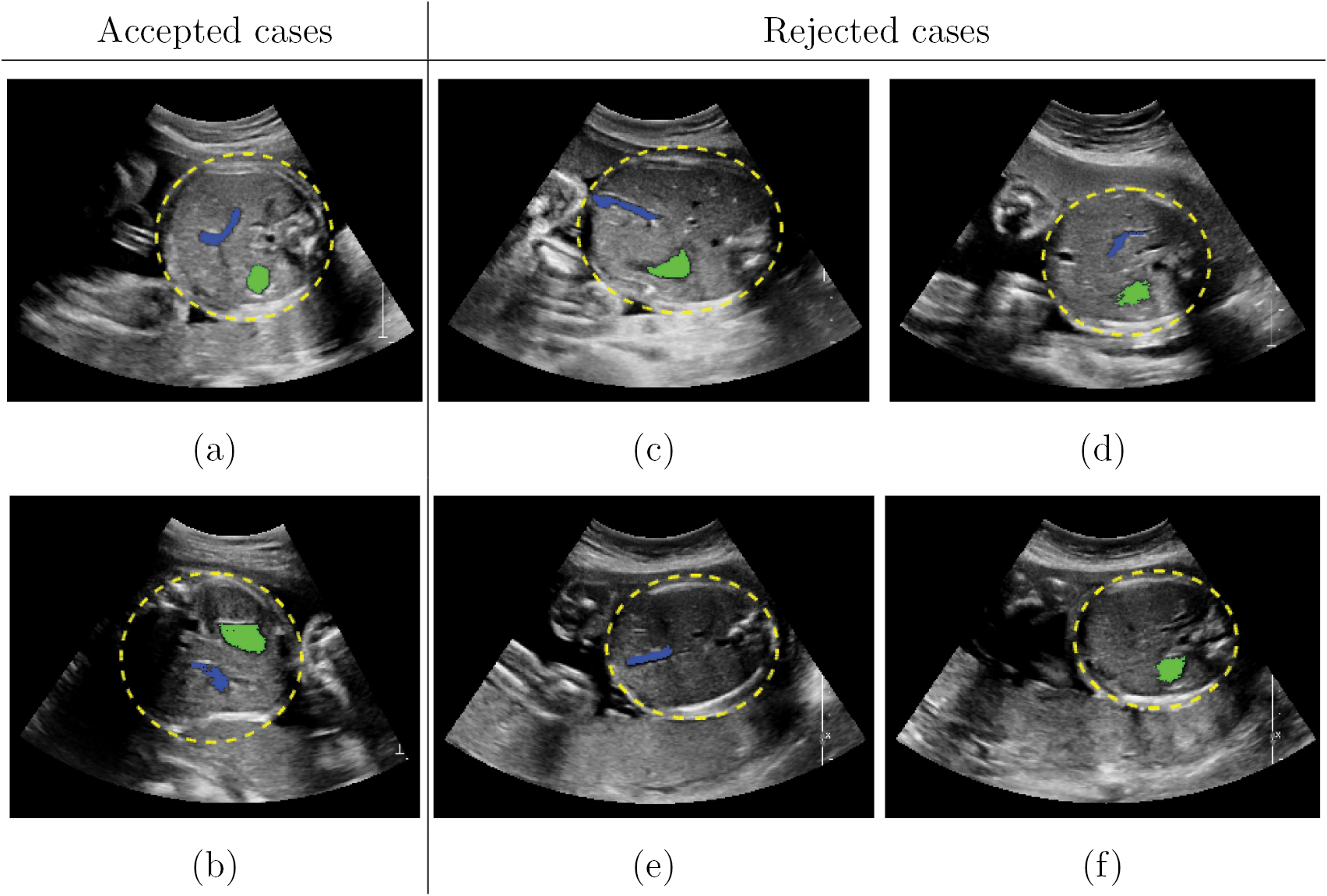 Machine-learning-based automatic identification of fetal abdominal ...