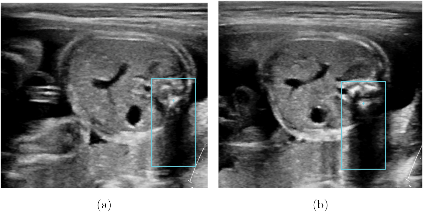 Machine-learning-based automatic identification of fetal abdominal ...