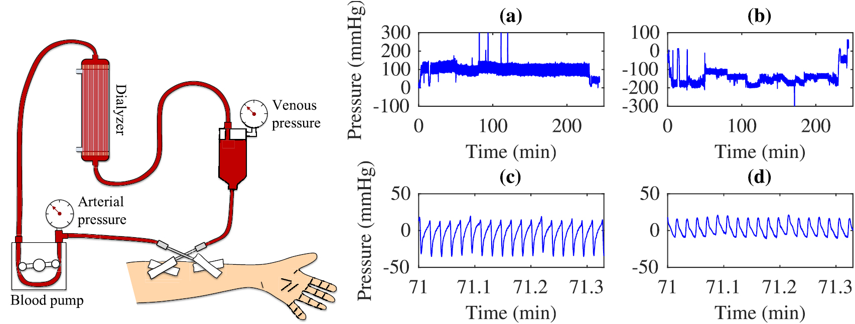 Monitoring respiration using the pressure sensors in a dialysis machine ...