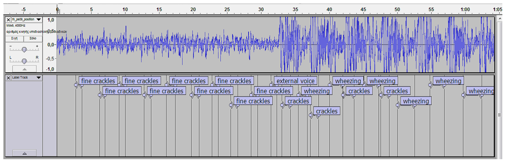 An open access database for the evaluation of respiratory sound classification algorithms ...