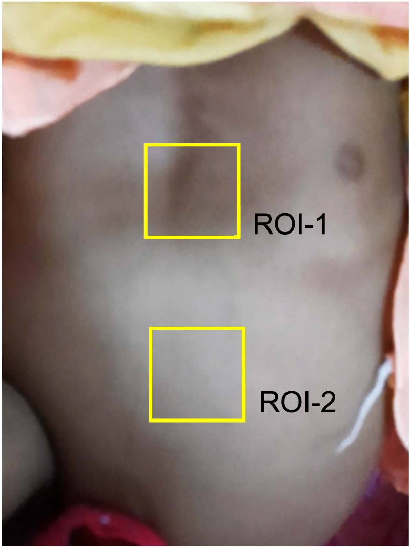 Video based non-contact monitoring of respiratory rate and chest ...