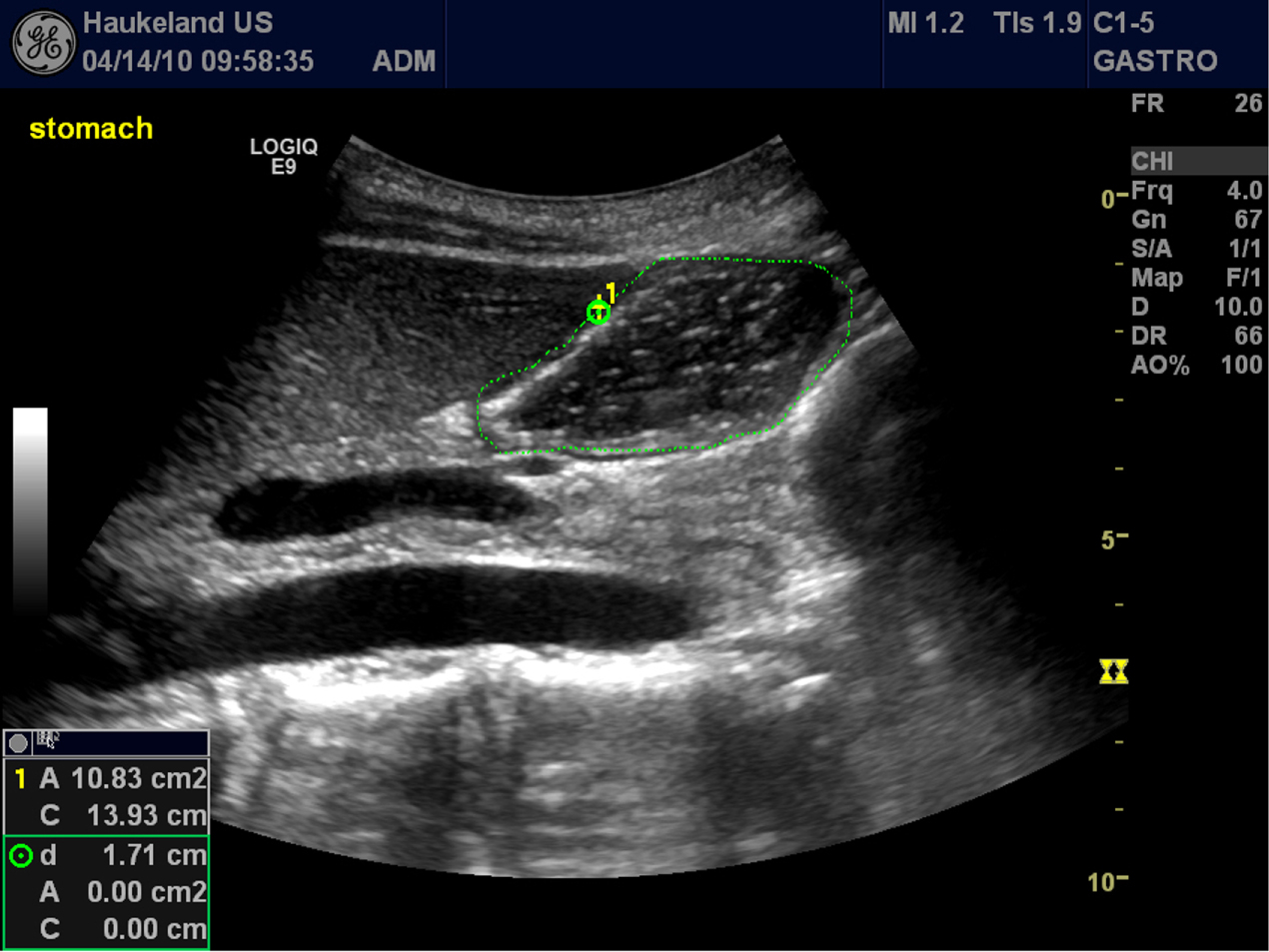 Ultrasound imaging for assessing functions of the GI tract - IOPscience