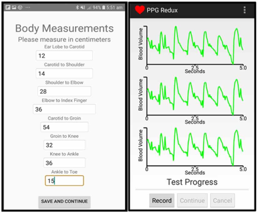 The use of multi-site photoplethysmography (PPG) as a screening tool ...