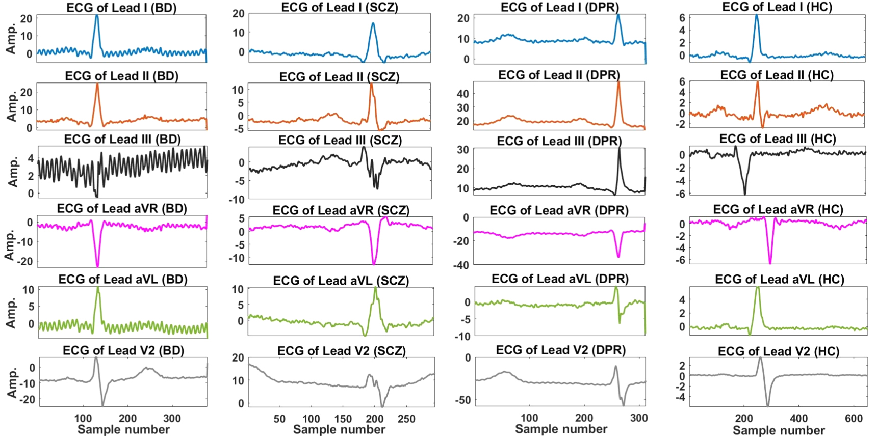 ECGPsychNet: an optimized hybrid ensemble model for automatic detection of psychiatric disorders ...