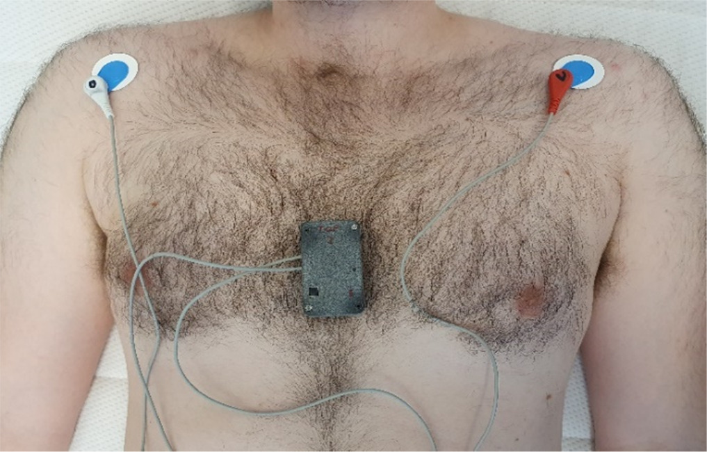 Mechanocardiography detects improvement of systolic function caused by ...