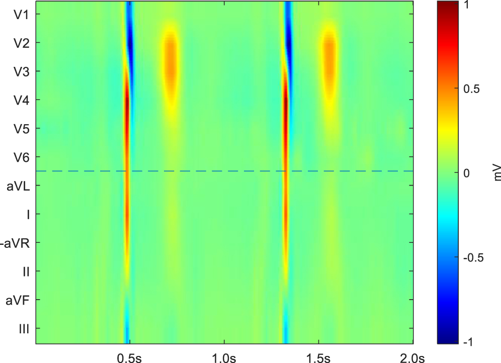 3D ECG display with deep learning approach for identification of ...
