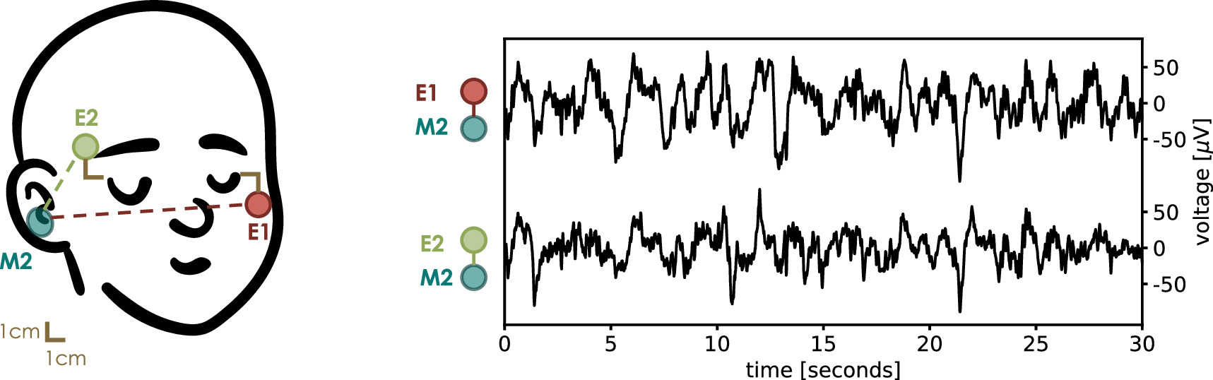 Single-channel EOG sleep staging on a heterogeneous cohort of subjects ...