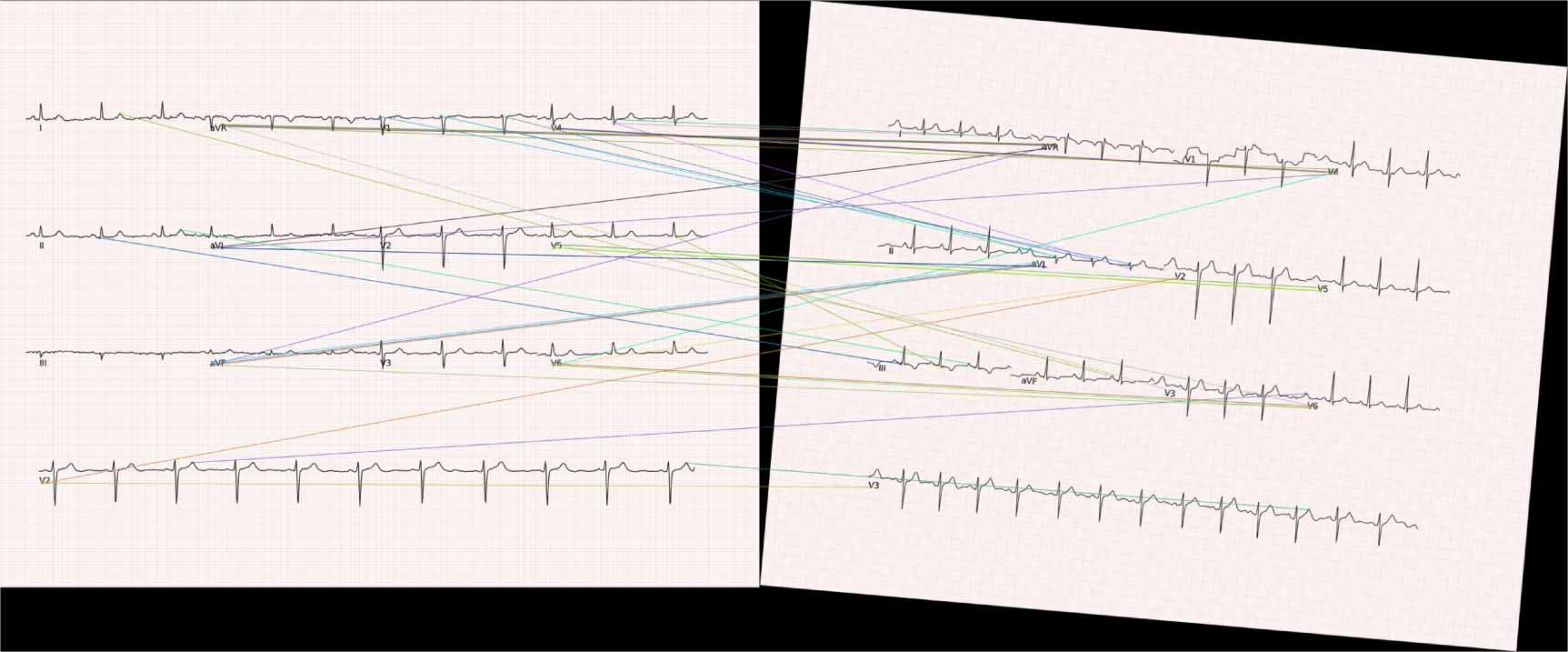 ECG-Image-Kit: a synthetic image generation toolbox to facilitate deep ...