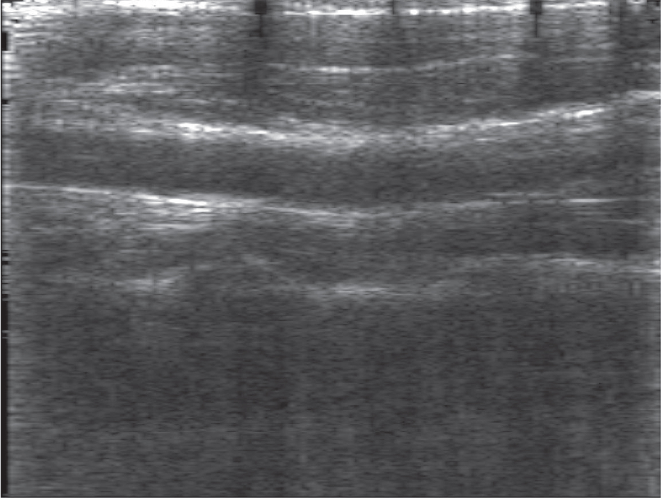 Thin, flexible, and biocompatible medical ultrasound array transducer ...