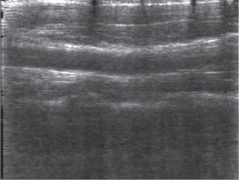 Thin, flexible, and biocompatible medical ultrasound array transducer ...