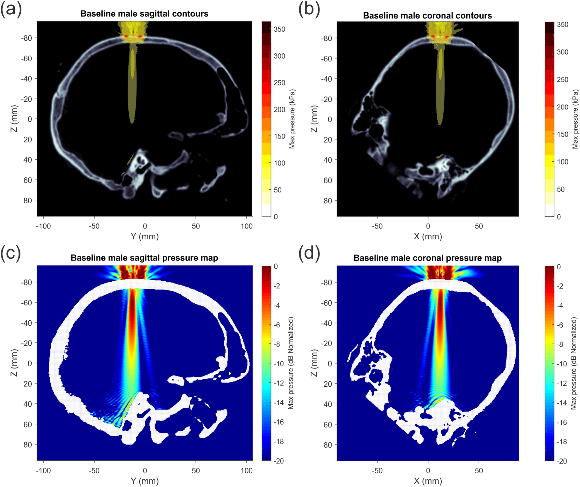 Numerical evaluation of the skull for human neuromodulation with ...