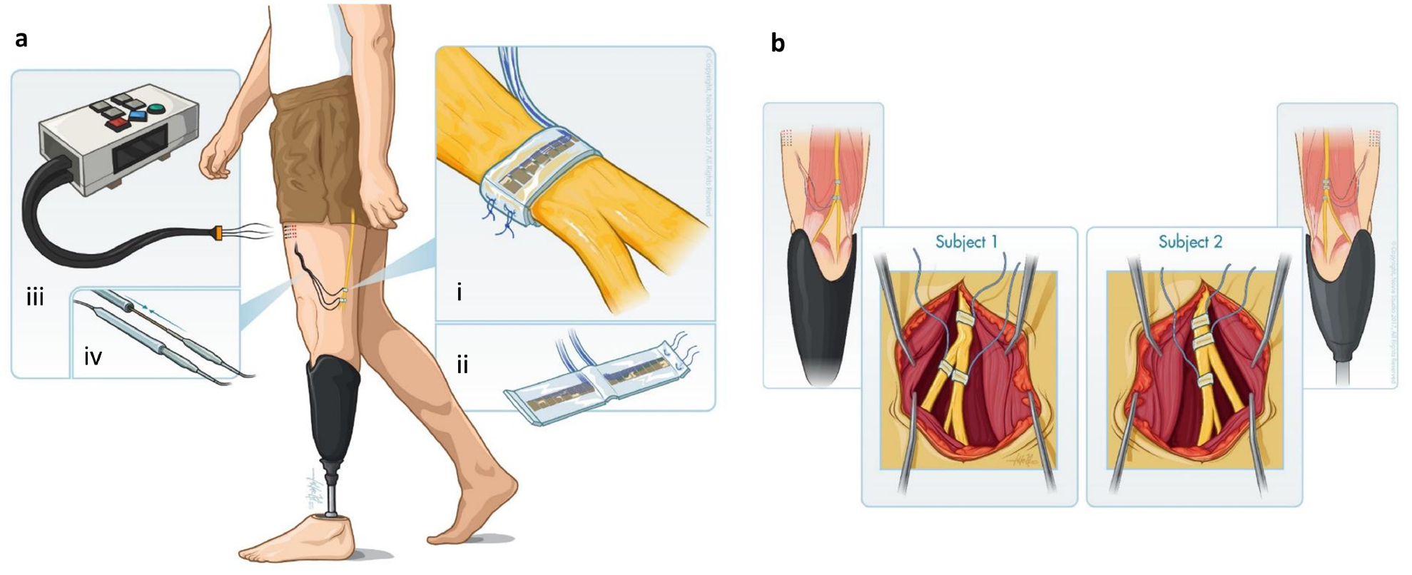 High-density peripheral nerve cuffs restore natural sensation to ...