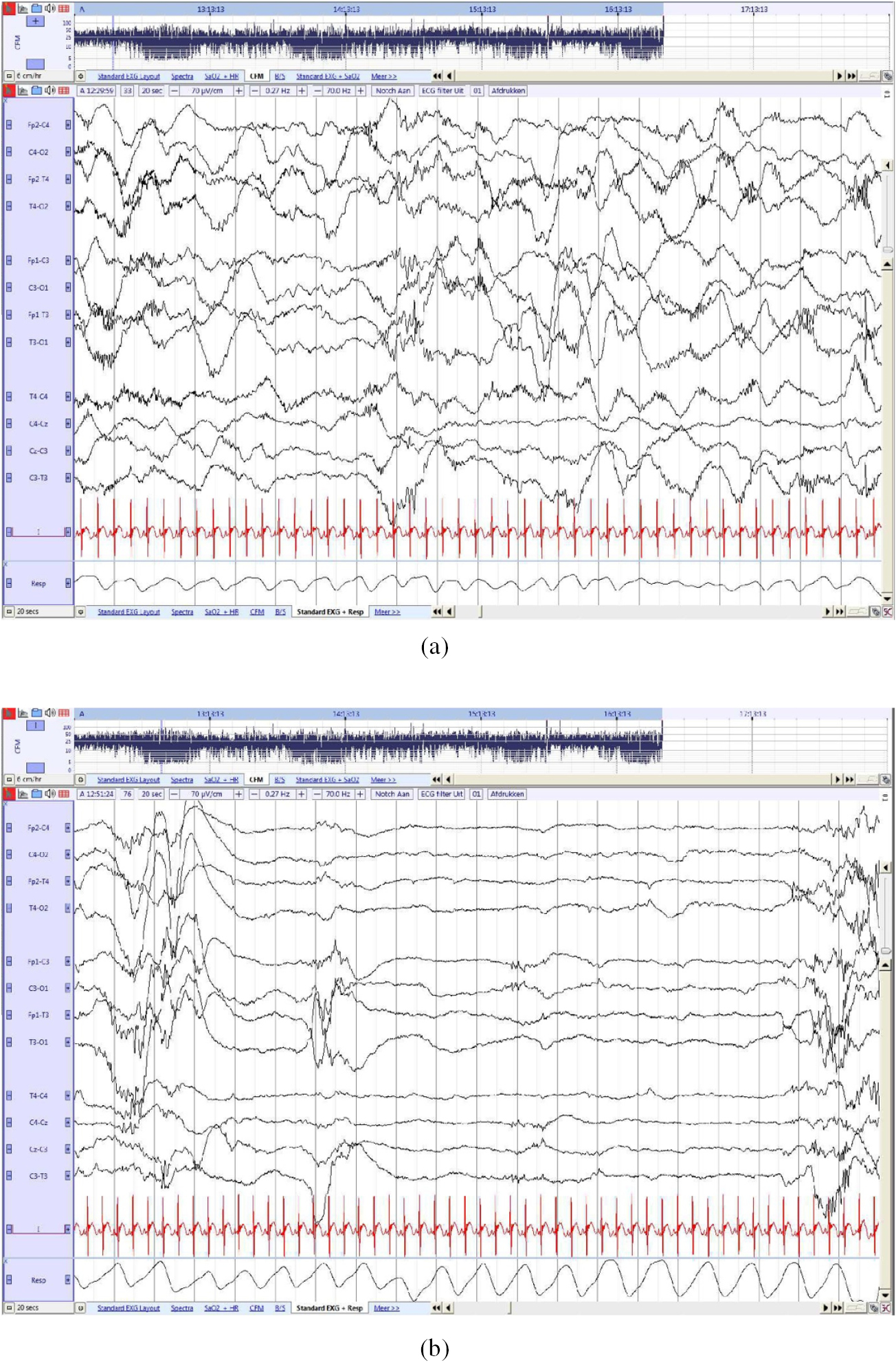 Quiet sleep detection in preterm infants using deep convolutional ...