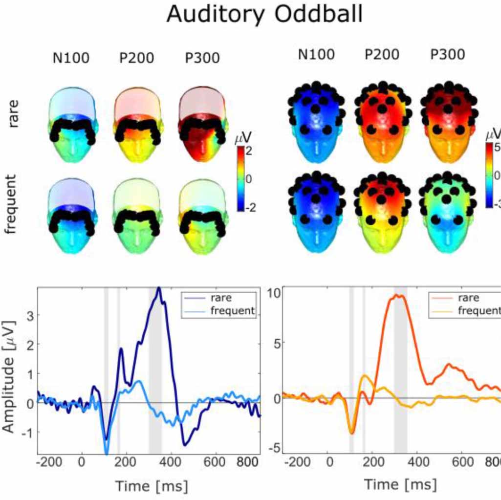 Flex-printed forehead EEG sensors (fEEGrid) for long-term EEG ...