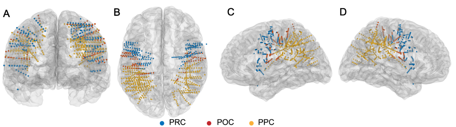 Enhancing gesture decoding performance using signals from posterior parietal cortex: a stereo ...