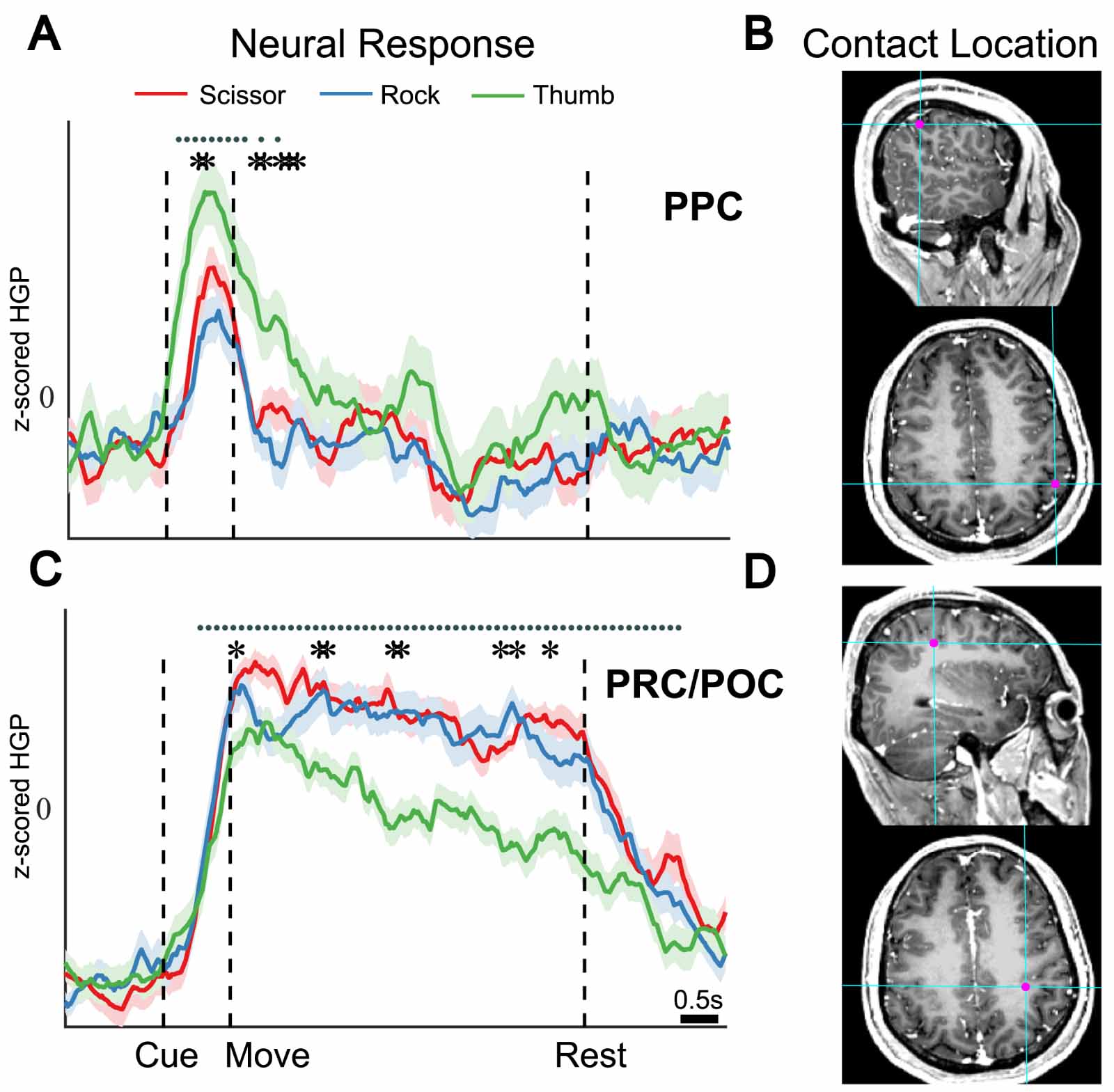 Enhancing gesture decoding performance using signals from posterior parietal cortex: a stereo ...
