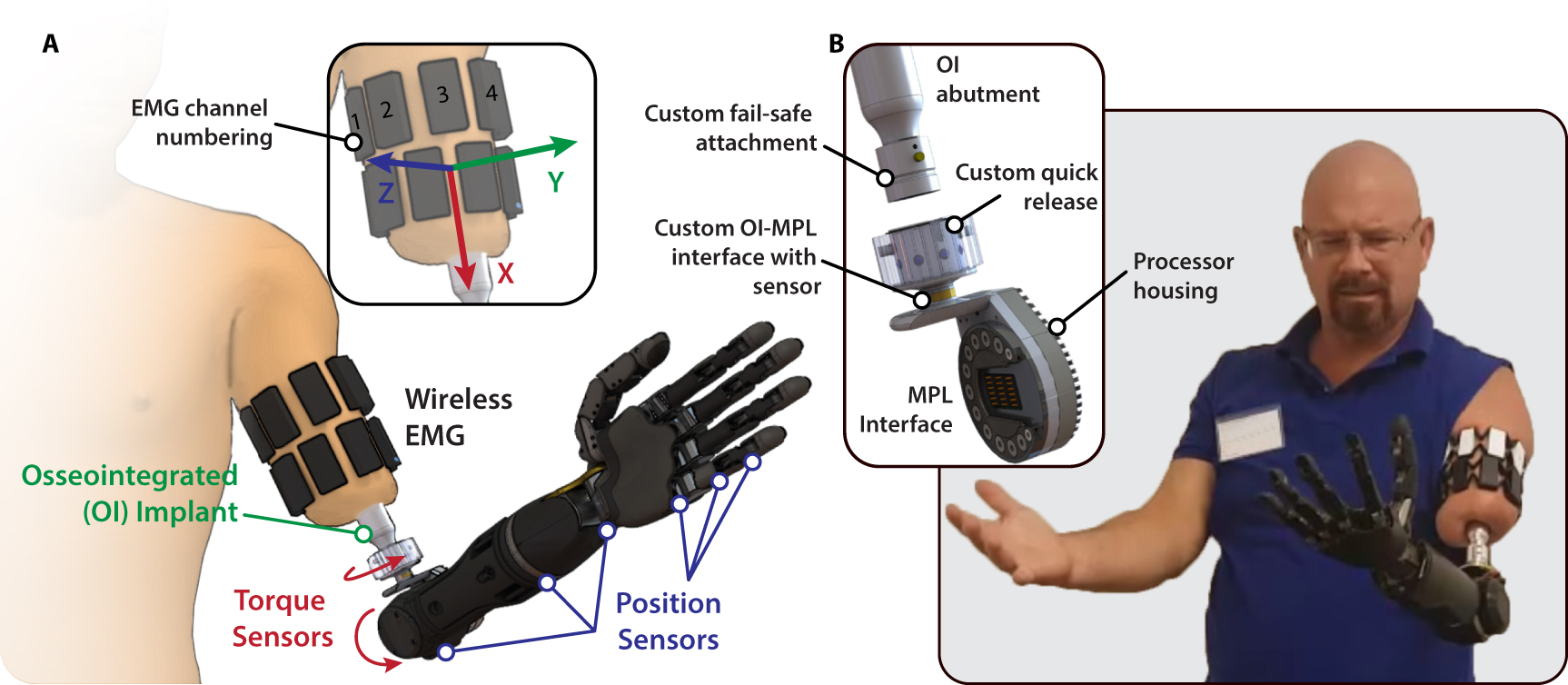 Extended home use of an advanced osseointegrated prosthetic arm improves function, performance ...