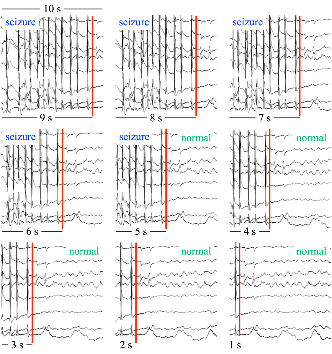 Epileptic seizure detection by using interpretable machine learning ...