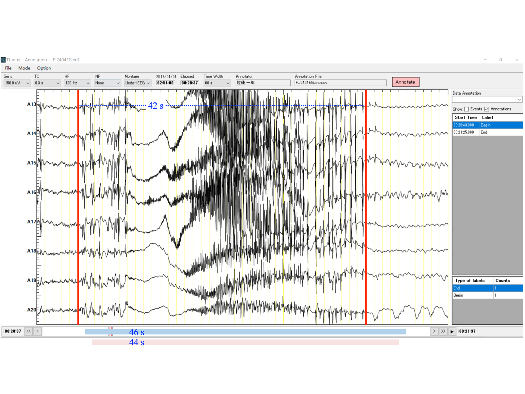 Epileptic seizure detection by using interpretable machine learning ...